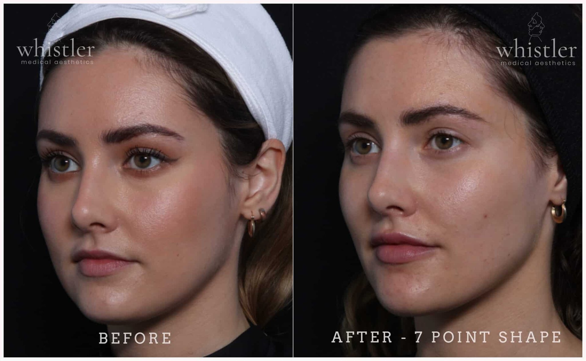 Unlocking Beauty: The 7 Point Shape Technique & MD Codes | Whistler ...