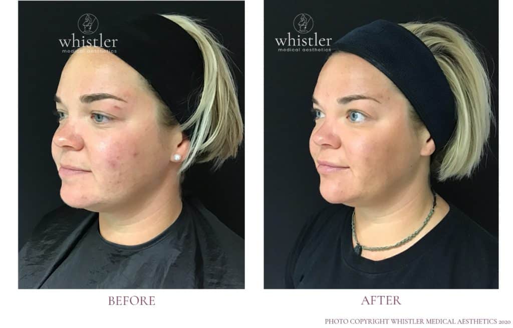 MD Codes™: The Only Approach To Facial Aesthetic Injectables - Whistler ...