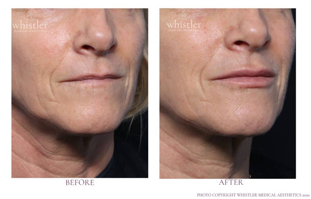 MD Codes™: The Only Approach To Facial Aesthetic Injectables - Whistler ...