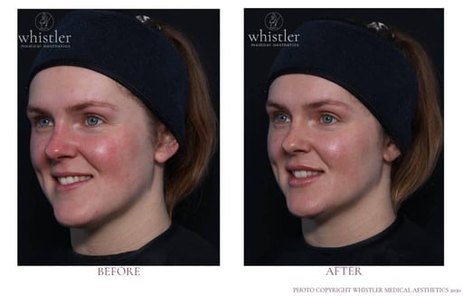 MD Codes™: The Only Approach To Facial Aesthetic Injectables - Whistler ...