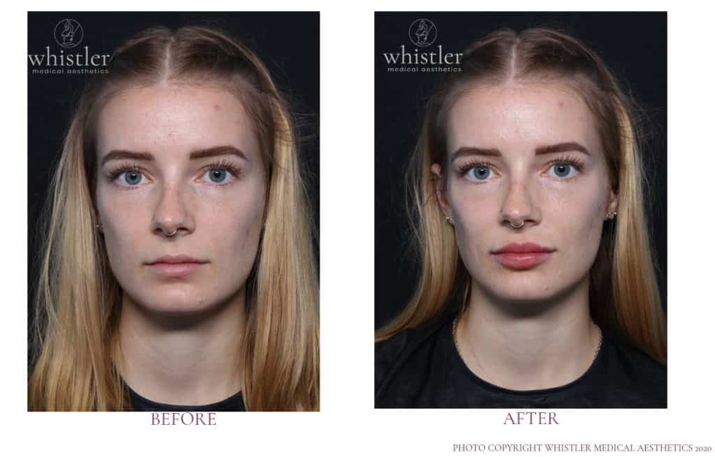 MD Codes™: The Only Approach To Facial Aesthetic Injectables - Whistler ...