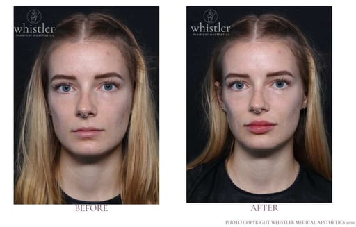 MD Codes™: The Only Approach To Facial Aesthetic Injectables - Whistler ...