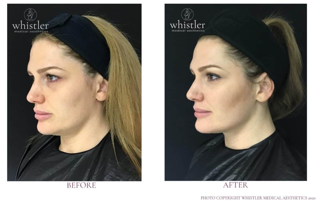 MD Codes™: The Only Approach To Facial Aesthetic Injectables - Whistler ...