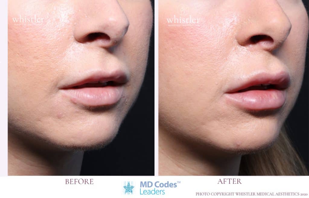 MD Codes™: The Only Approach To Facial Aesthetic Injectables - Whistler ...