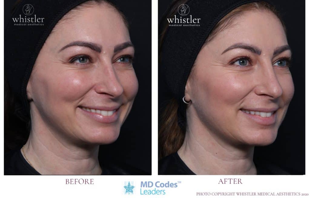 MD Codes™: The Only Approach To Facial Aesthetic Injectables - Whistler ...