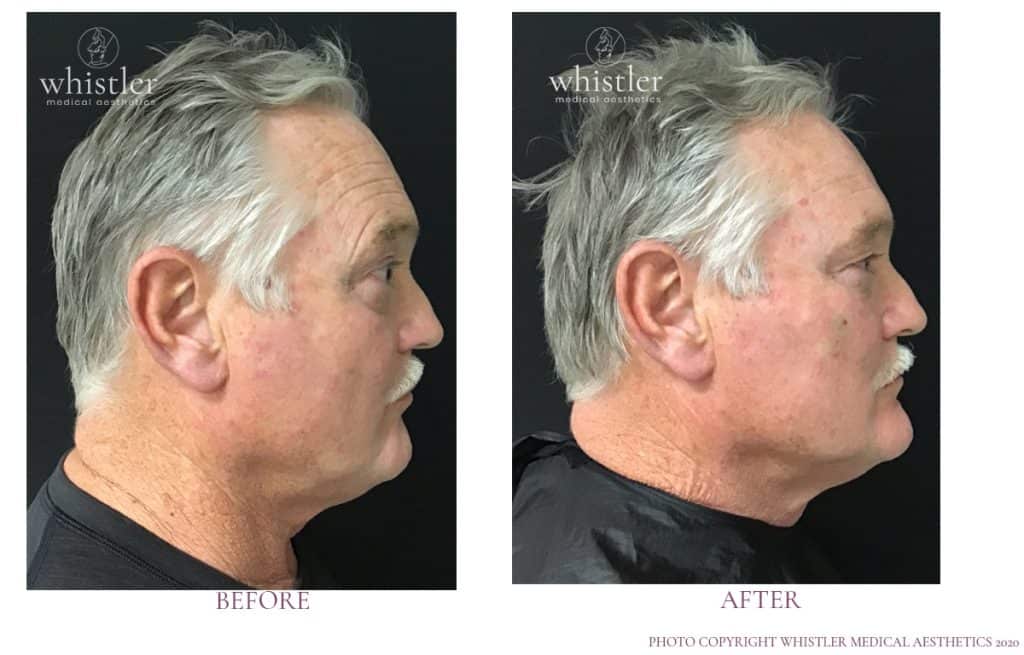 MD Codes™: The Only Approach To Facial Aesthetic Injectables - Whistler ...
