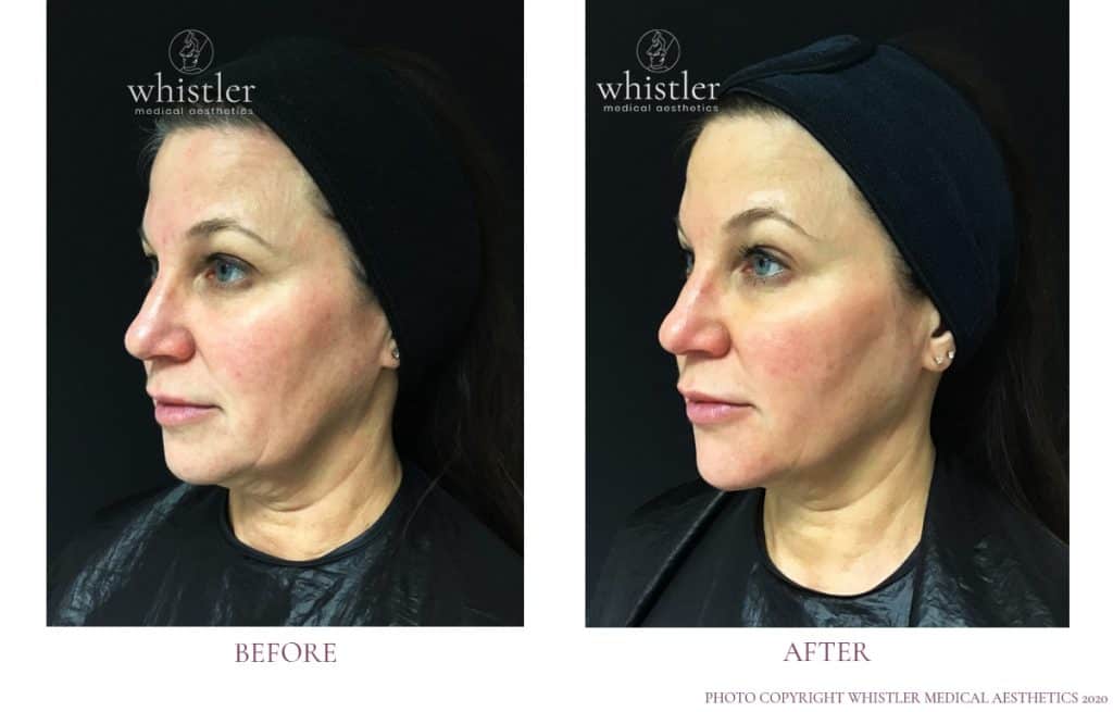 MD Codes™: The Only Approach To Facial Aesthetic Injectables - Whistler ...