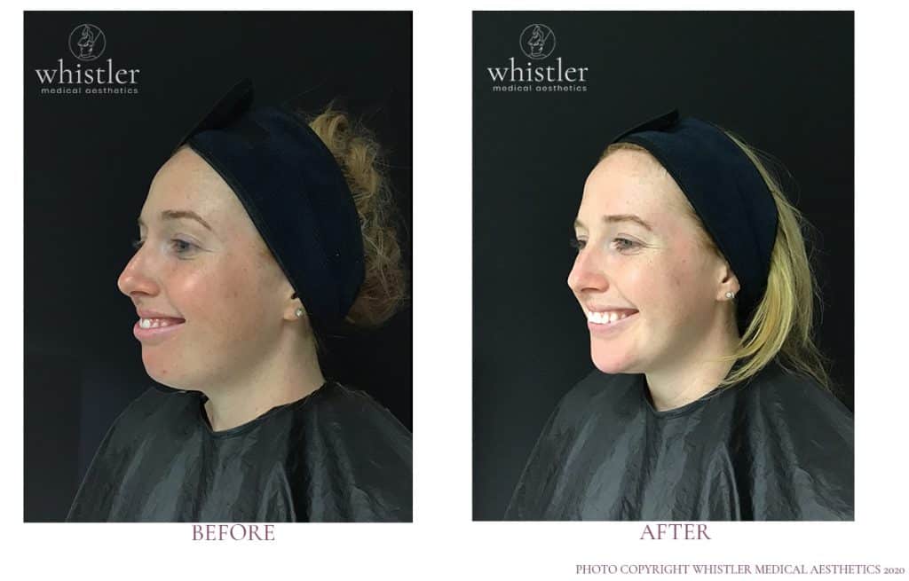MD Codes™: The Only Approach To Facial Aesthetic Injectables - Whistler ...