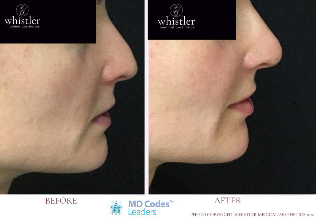 MD Codes™: The Only Approach To Facial Aesthetic Injectables - Whistler ...