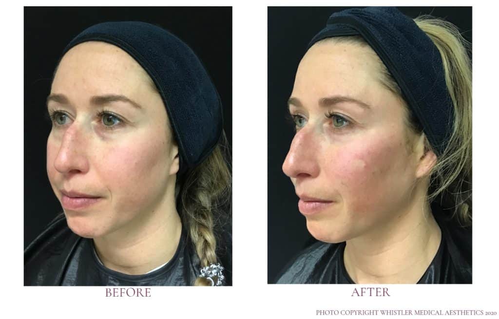 MD Codes™: The Only Approach To Facial Aesthetic Injectables - Whistler ...