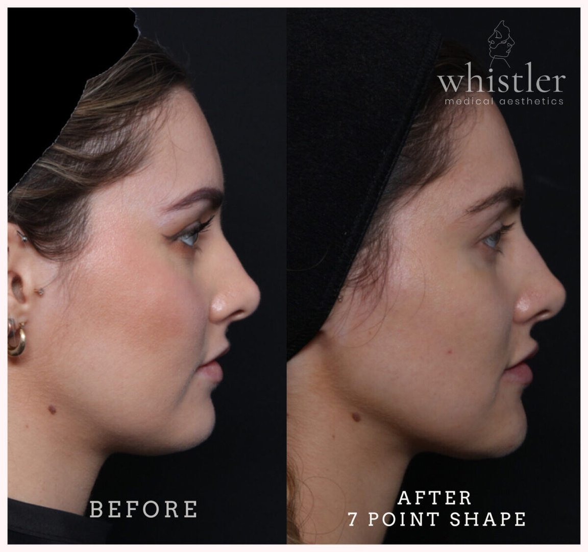 Unlocking Beauty: The 7 Point Shape Technique & MD Codes | Whistler ...