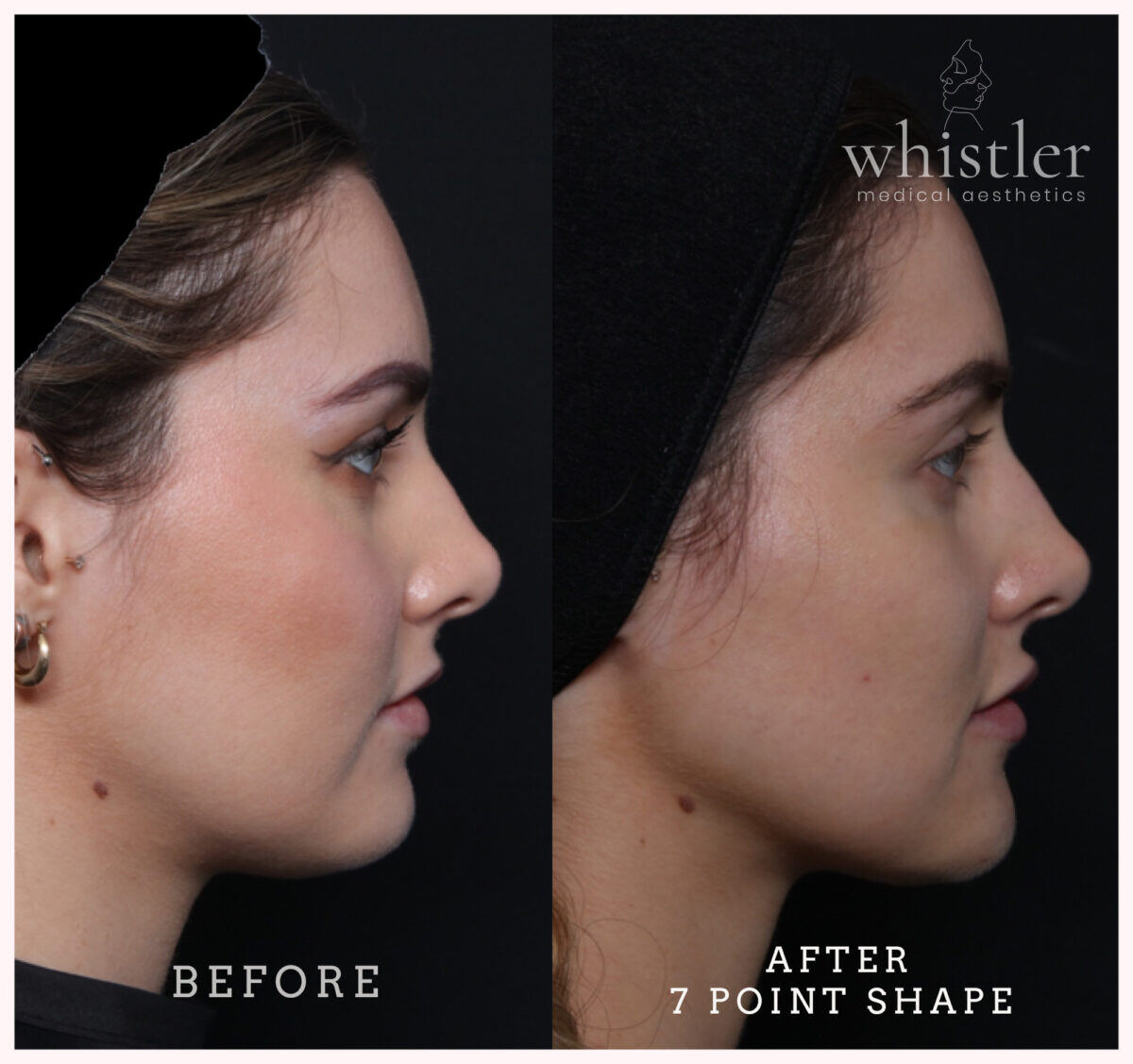 Unlocking Beauty: The 7 Point Shape Technique & MD Codes | Whistler ...